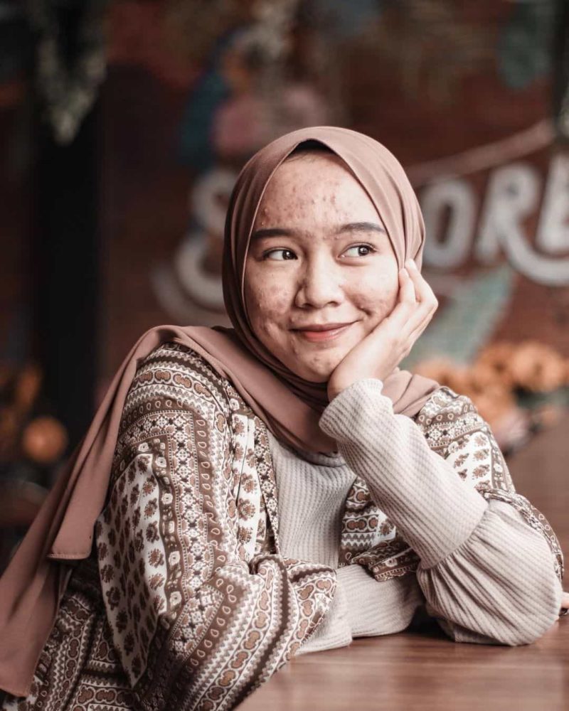 10 Potret Novia Nur Ismi, Selebgram Acne Fighter yang Inspiratif - Dailysia